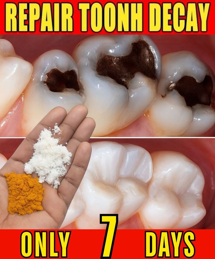 100% Natural Home Remedy for Tooth Decay, Yellow Teeth, and Tooth Pain ...