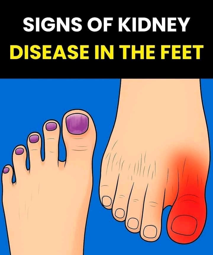 Signs of Kidney Disease in the Feet – Best Recipes