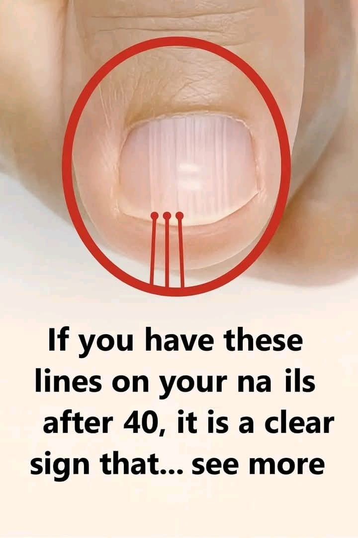 If Lines Start Appearing On Your Nails After 40, It Could Be A Warning ...