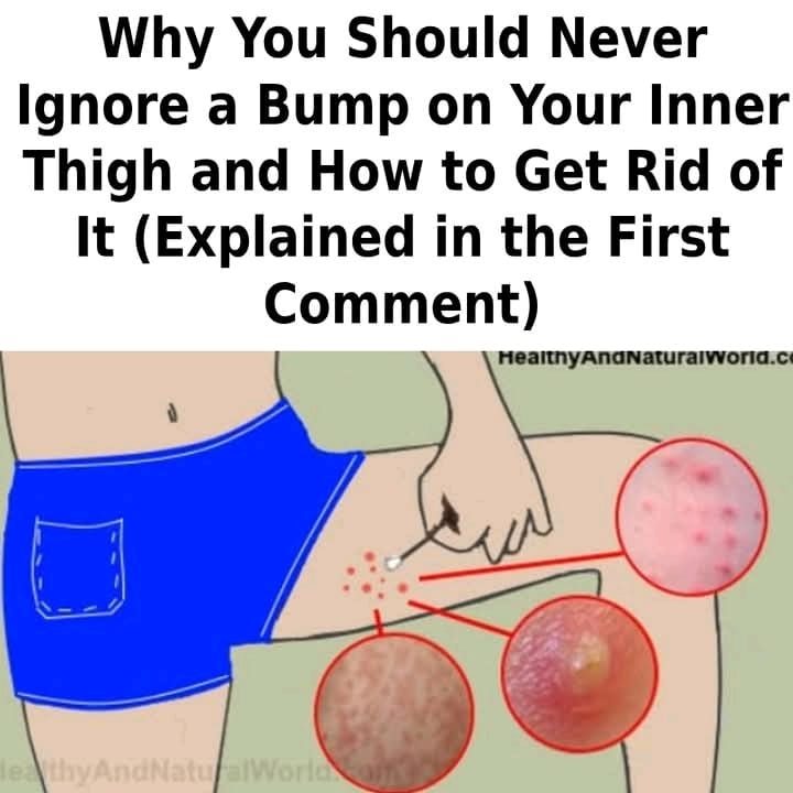 The Most Effective Ways to Get Rid of Bumps on Inner Thigh – Best Recipes
